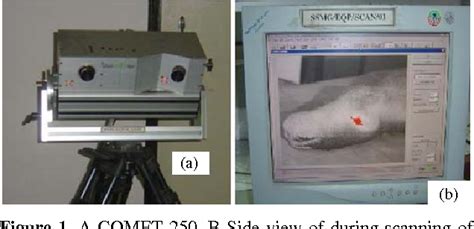 Figure 2 From Analysis Of Trans Tibial Prosthetic Socket Materials Using Finite Element Method