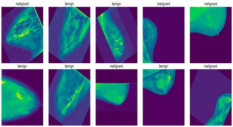 Breast Cancer Classification Using Fine Tuned Swin Transformer Model On