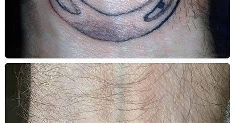 Complete Removal On Brand New Tattoo Did Not Begin Treatment For 16
