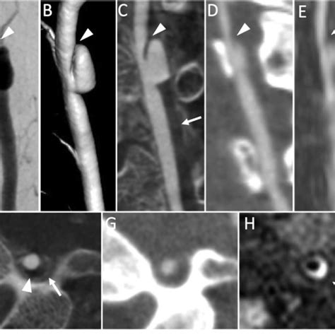 Imagings Showing The Left Vertebral Artery Dissection In The V2 Segment Download Scientific