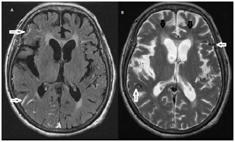 Diffuse Proliferative Cerebral Angiopathy A Case Report And Review Of The Literature PMC