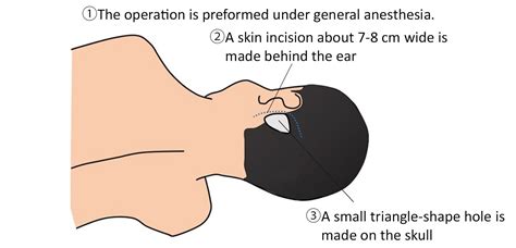 We Provide Innovative Treatments For Trigeminal Neuralgia Ntt Medical Center Tokyo