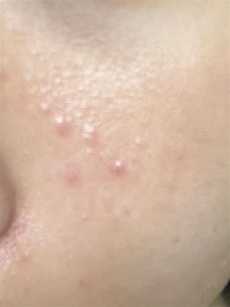 여드름 이거 어떻게 해결 하나요ㅠㅠ 지식in