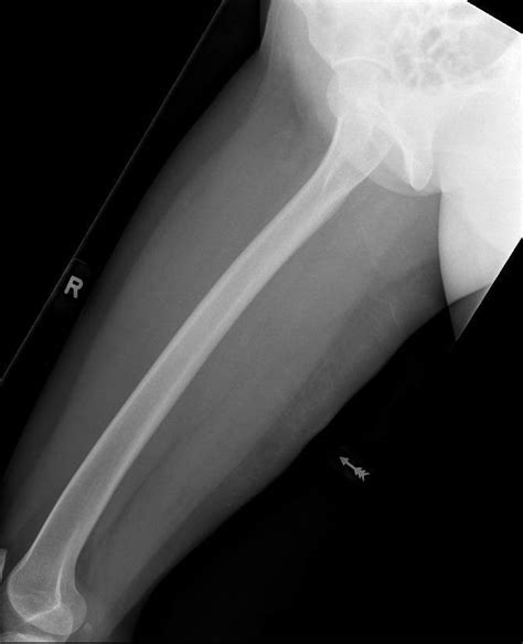 Lateral Femur X Ray Labeled At Arthur Popp Blog