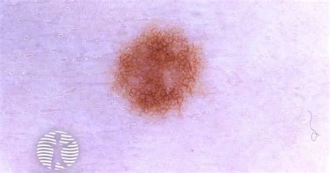 Dermoscopy Reticular Pattern Naevus Image Dermoscopy Reticular Pattern Naevus Image