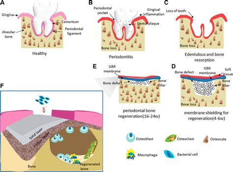 Barrier Membrane Technique At Joanne Magana Blog