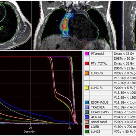 Dose Distribution Of Stereotactic Radiotherapy In 5 Fractions Using The
