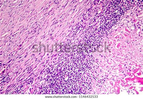 Pericarditis Inflammation Heart Pericardium Light Micrograph Stock