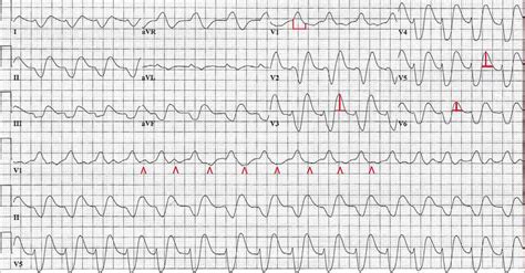 Sine Wave Ecg Pattern