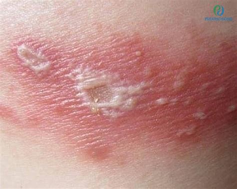 Dấu Hiệu Và Cách Xử Lý Kiến Ba Khoang Cắn