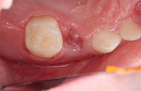 Extraction Of A Milk Tooth And Placement Of A Placeholder сases Of