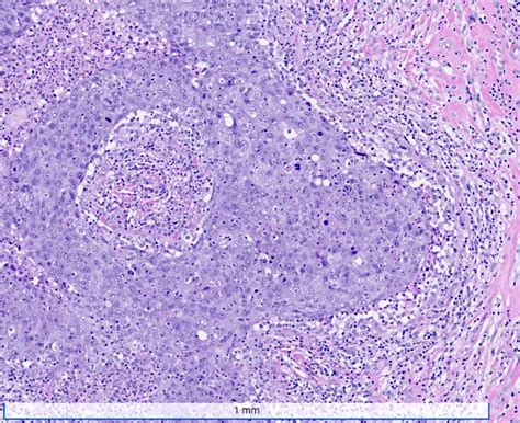 Pathology Outlines Medullary
