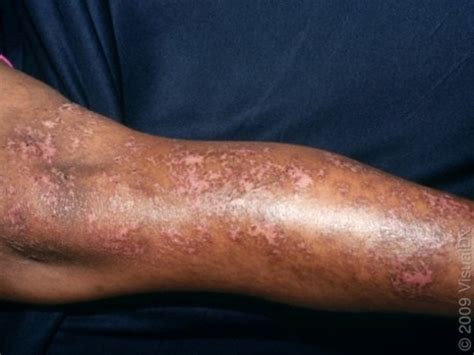 Dark Spots On Lower Legs Diabetes - Infoupdate.org