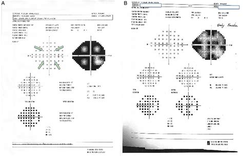 Which Is And Nasal Visual Field Interpretation