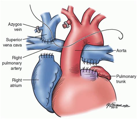 Tricuspid Atresia Single Ventricle And The Fontan Operation Thoracic Key