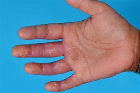 Atopic Dermatitis Hands