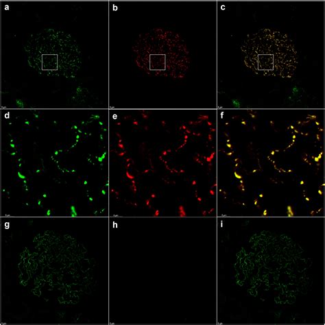 Target Antigens Of Membranous Nephropathy With Syphilis Infection