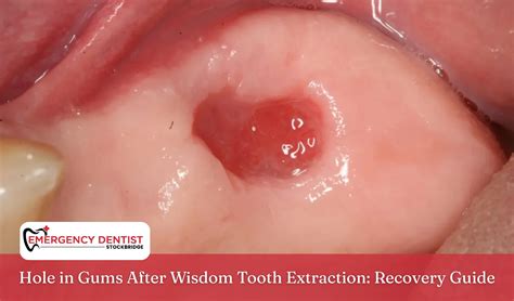 Hole In Gums After Wisdom Tooth Extraction Recovery Guide