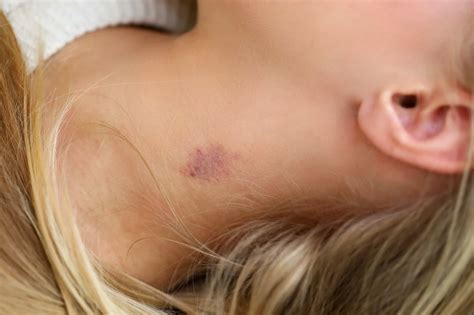 How To Give Yourself A Hickey 17 Tips That Really Work Her Norm