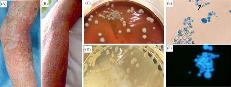 Multiple Cutaneous Infections Caused By Prototheca Wickerhamii Pmc