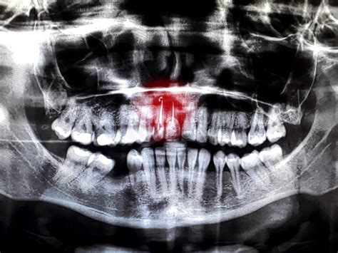 Panoramic Dental X Ray Two Root Canal Treatments With Red Area Stock