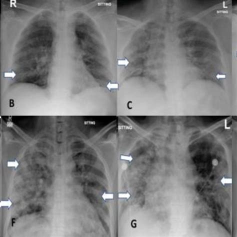Cxr Patterns A Left Lower Zone Consolidation B Bilateral Lower Zone