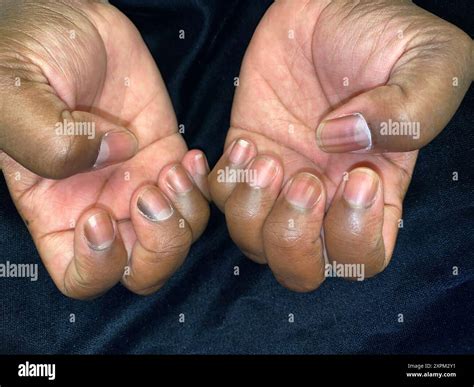 Nails Of A 34 Year Old African American Female Patient With