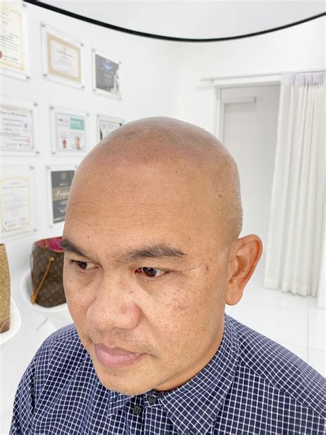 Scalp Micropigmentation Smp Bangkok Beauty Academy