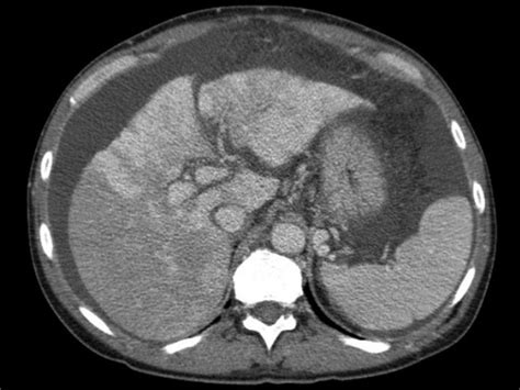 Liver Atlas Diagnosis Hepatocellular Necrosis