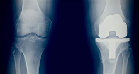 The Challenges Associated With Revision Arthroplasty Orthofix