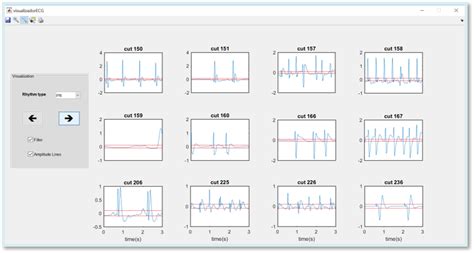 Ecg Based Algorithm For Annotation Of Resuscitation Episode Maria Monzon