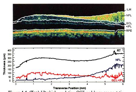 Enhanced Visualization Of Retinal Pathologies With Ultrahigh Resolution
