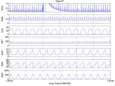Case 27 Waveform Plots 60 Second Plots