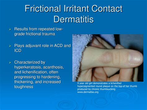 Ppt Contact Dermatitis Part One Powerpoint Presentation Free Download Id 335844