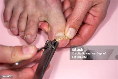 분홍색 배경에 고립 된 손 발톱 손톱 판에 기계적 손상 쉘 락 또는 젤 바니시 를 바른 후 손톱 손상 건강관리와 의술에 대한 스톡 사진 및 기타 이미지 Istock