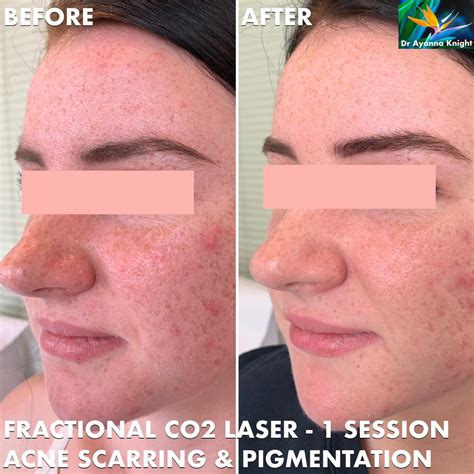 👩🏽‍💻 “how Can I Remove Pigmentation And Freckles”👩🏽‍💻 🙌 Safe And Effective
