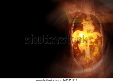Pet Ct Scan Reveals Cholangiocarcinoma Suspected Stock Illustration