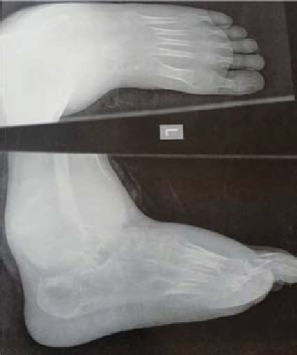 Xrayshow Lytic Lesion In The Cortical Bone Involve Distal Tibia And