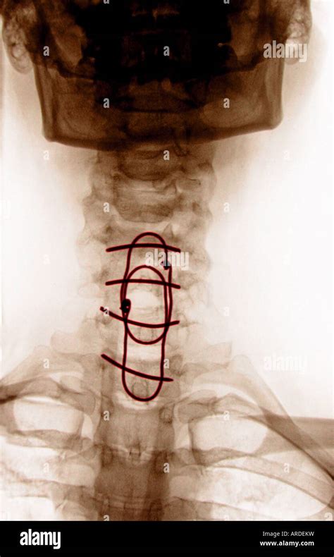 Cervical Spine X Ray Of A Year Old Female Who Underwent Surgery For A Fracture Of Her Neck