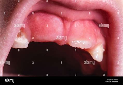 The Eruption Of A Permanent Tooth After The Loss Of A Milk Tooth In A