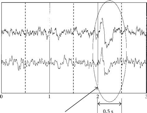 rejection of an eeg trial contaminated by an eye blink artefact