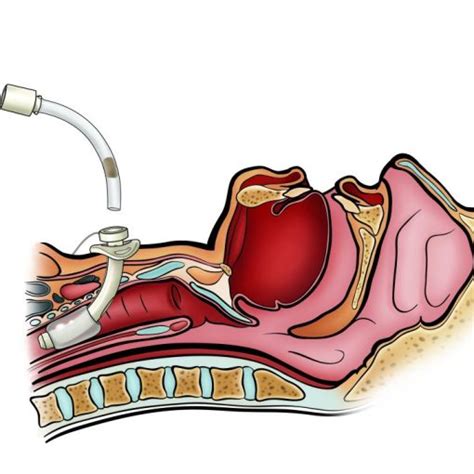 The Bleeding Tracheostomy First10em