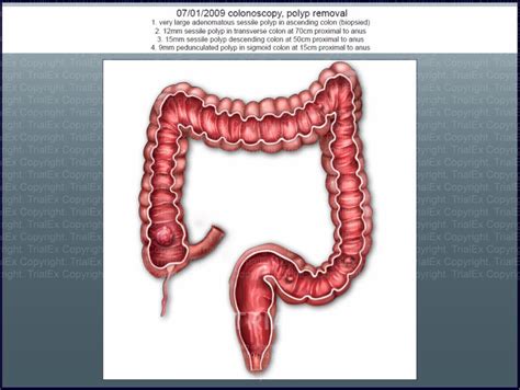 Colon Polyp Trialquest Inc