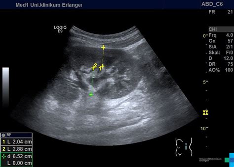 Pyelonephritis Atlas Of Ultrasound