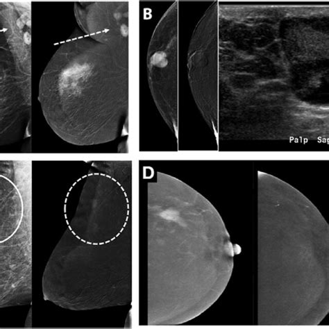 63 Year Old Woman With Left Breast Palpable Abnormality 7 Months Post Download Scientific