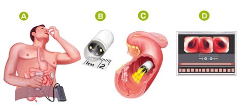 Video Capsule Endoscopy Gastroenterologist Murdoch