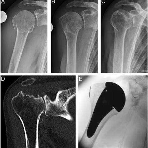 Post Fracture Stiffness In A 63 Year Old Female Patient Due To Download Scientific Diagram