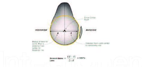 Glenoid Bone Loss Measurement Download Scientific Diagram