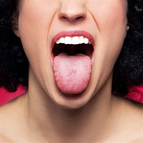 What Is Black Hairy Tongue Scott Arms