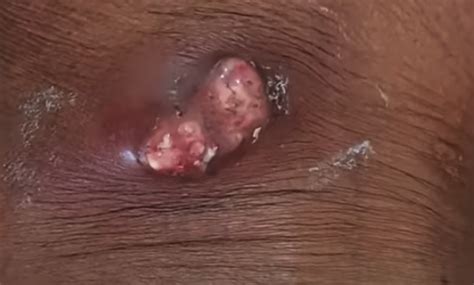 Big Infected Abscess On Back Drained New Pimple Popping Videos